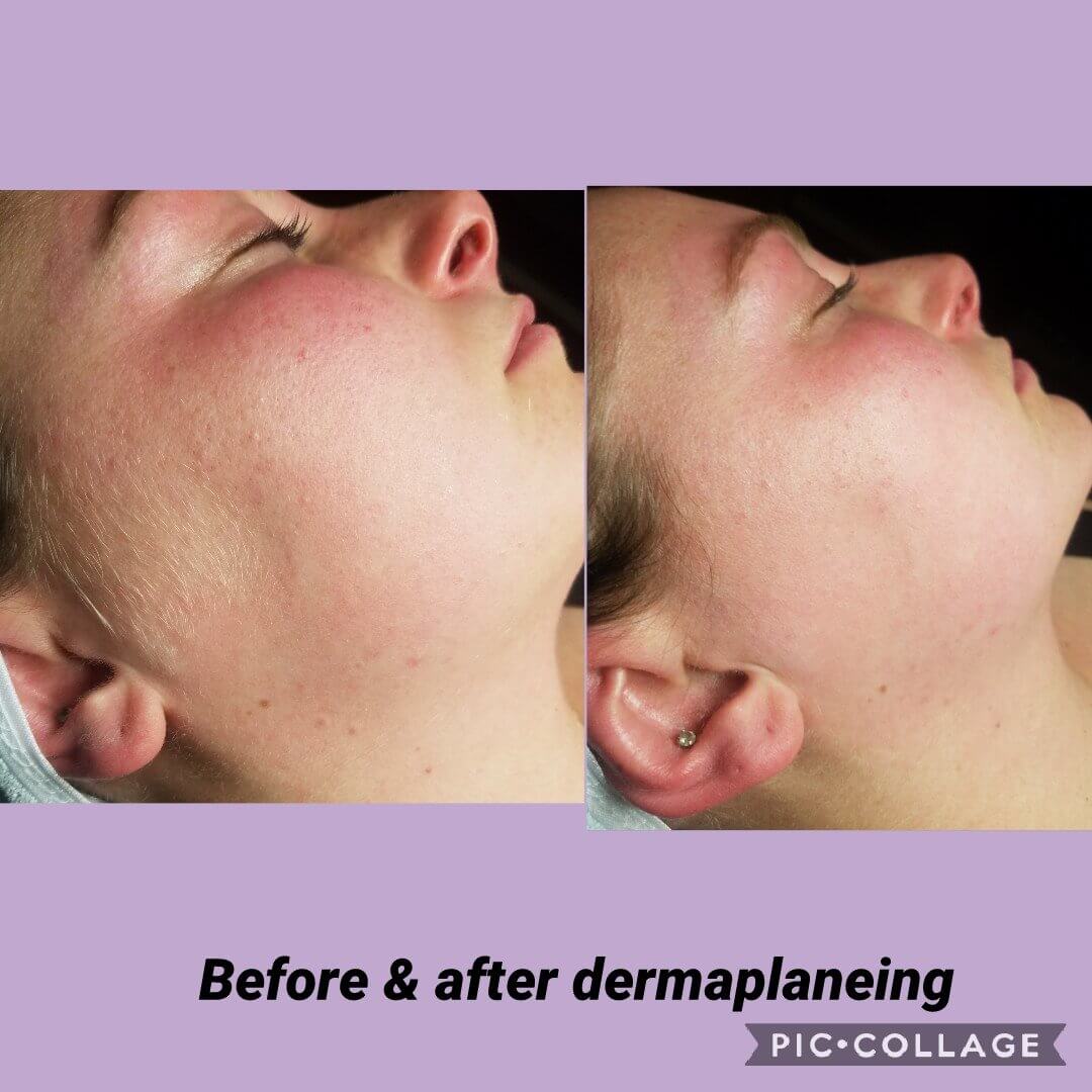 Dermaplane Facial Services | Skin Pro Lori