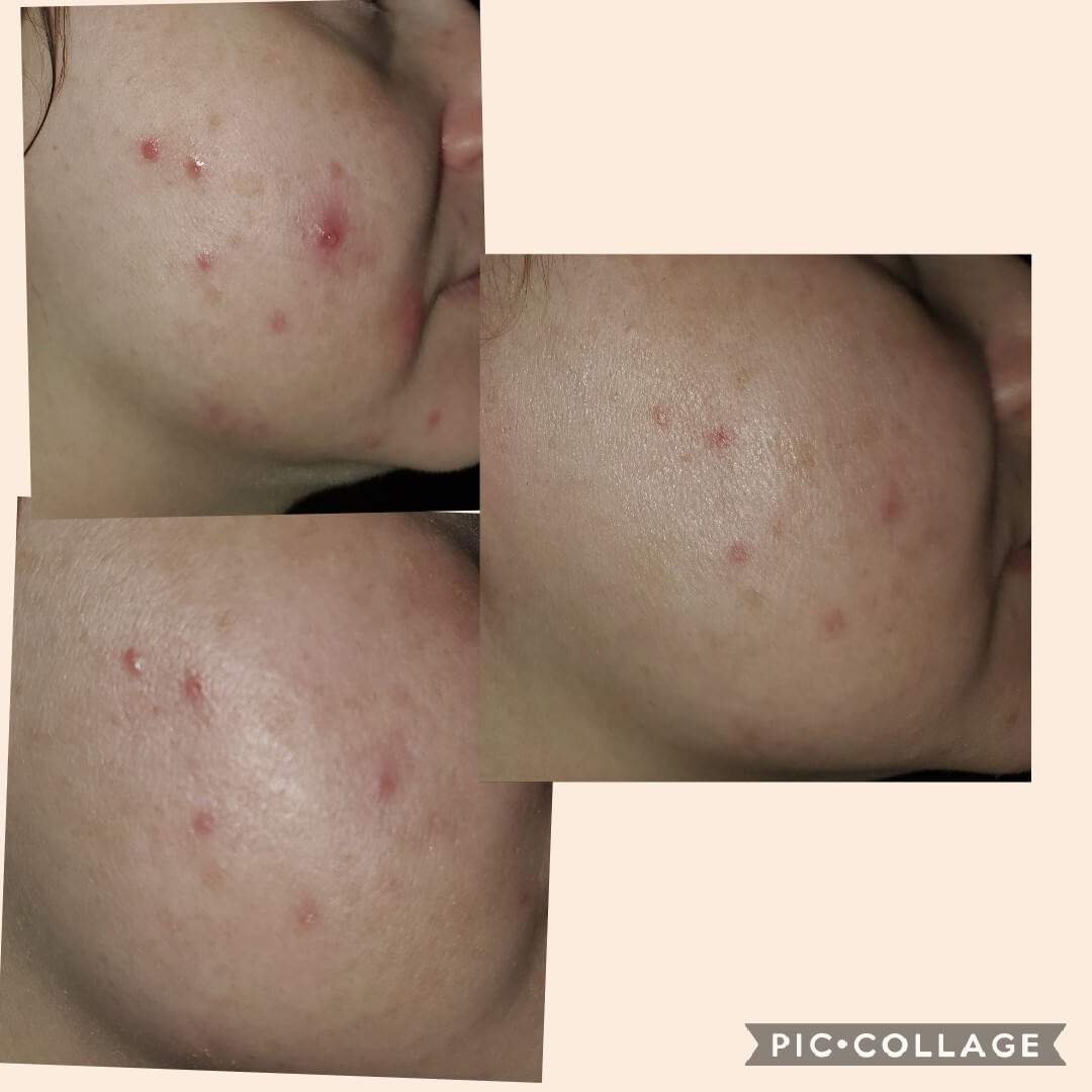 Before & After Pictures | Skin Pro Lori