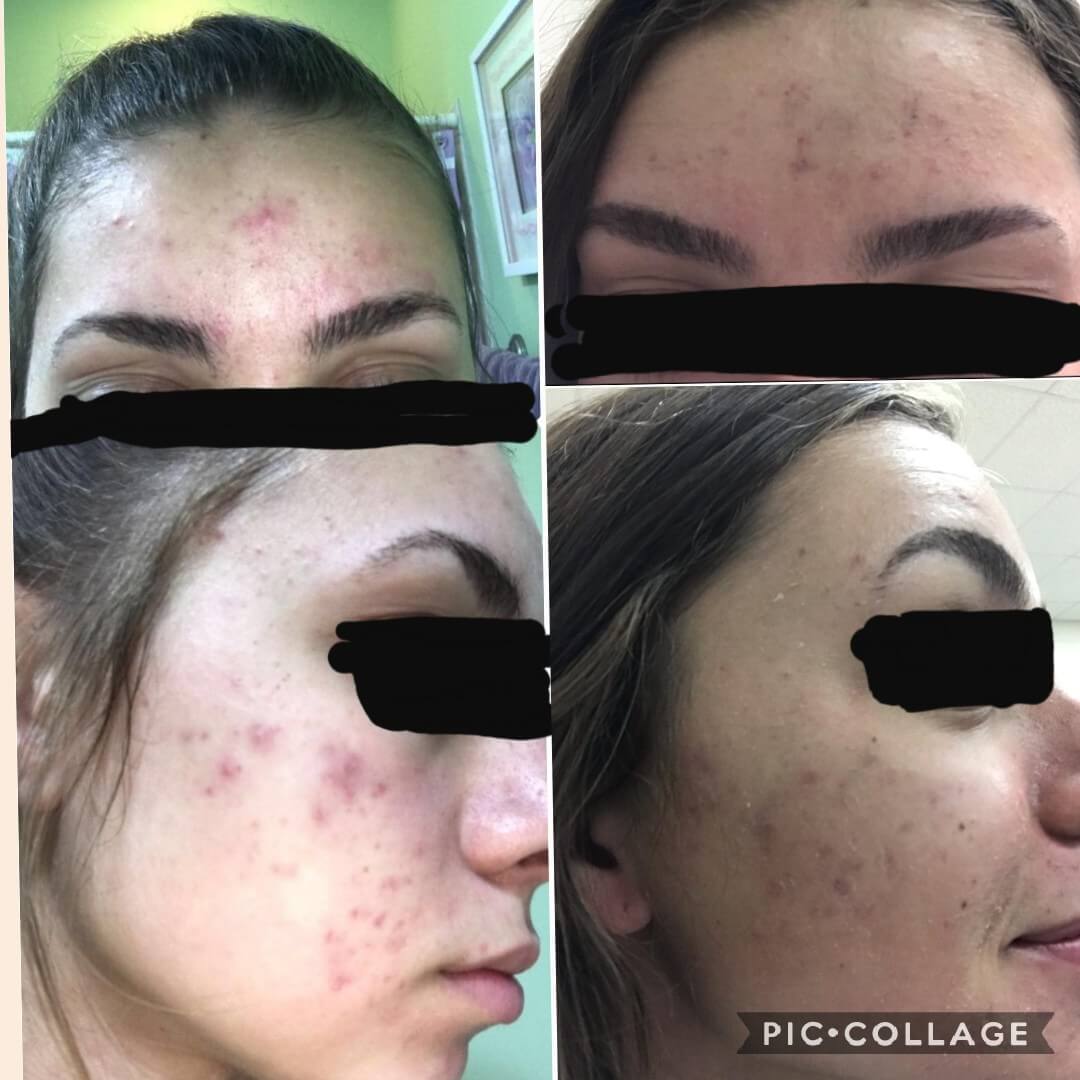 Before & After Pictures | Skin Pro Lori